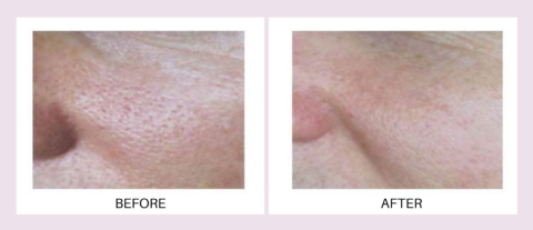 Before and After: See How NCTF Takes Years Off Your Face - Bella Pelle
