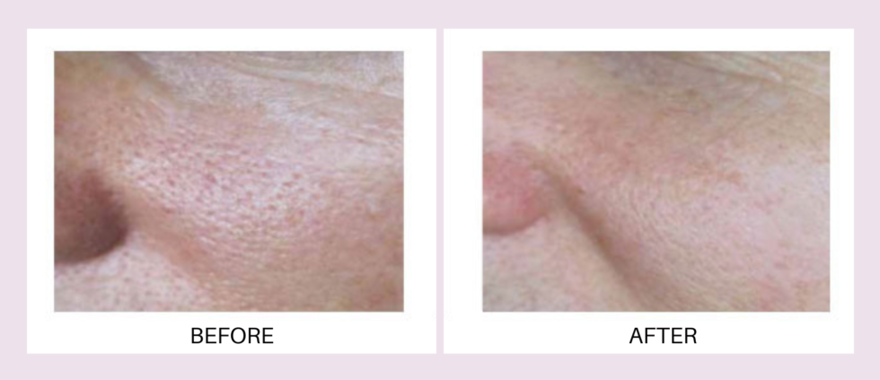 Before and After: See How NCTF Takes Years Off Your Face - Bella Pelle