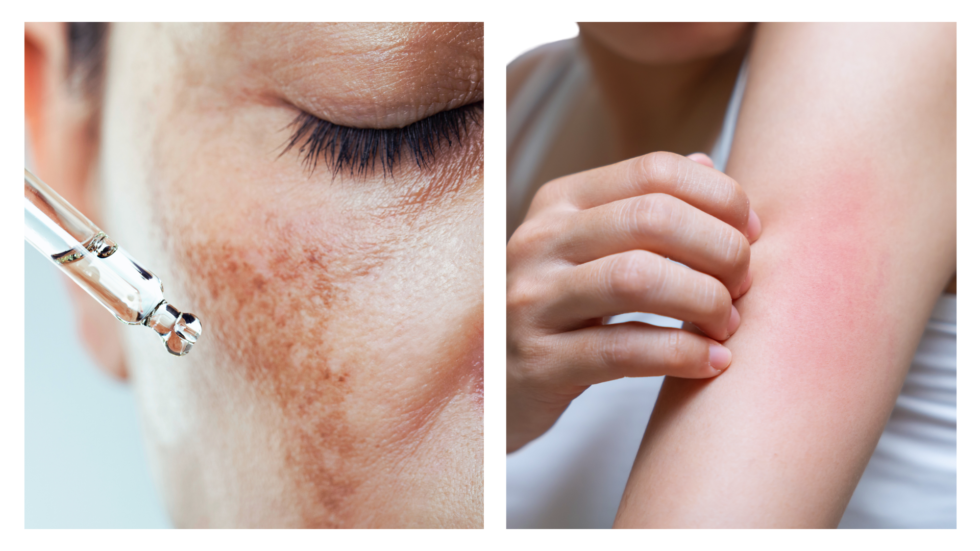 Your Quick Guide to Hot Weather Skin Woes - Bella Pelle